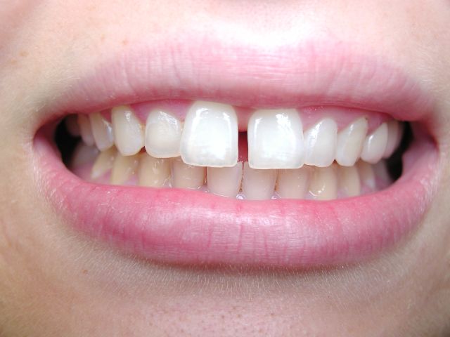 Spaces Between Teeth and How to Fix Them | My Smile 203-538-5014